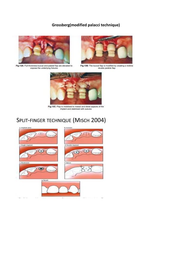 Soft tissue management around dental implant | PPTX