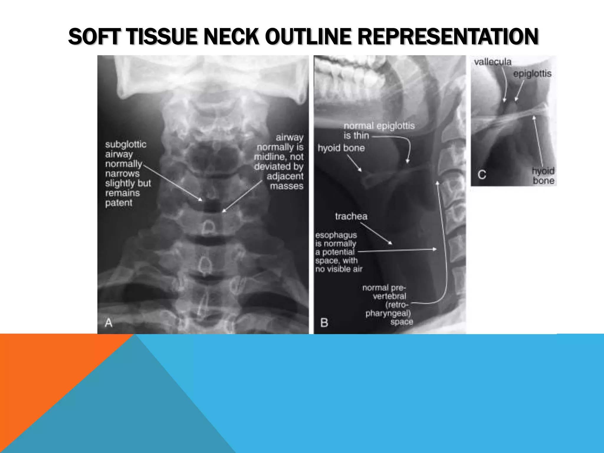 Soft tissue neck (upper airway) radiography | PPTX