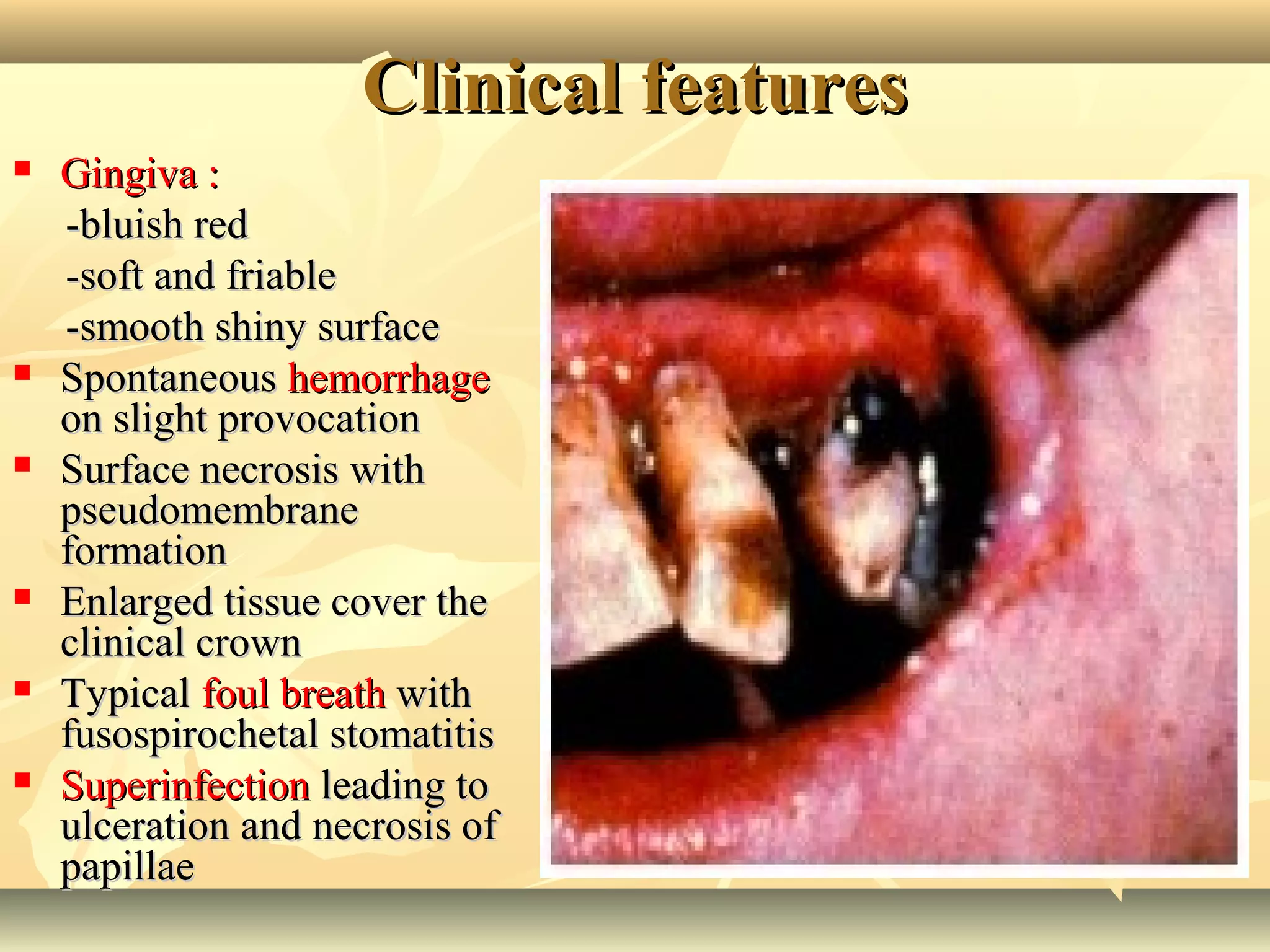 Soft tissue oral lesions in children | PPT