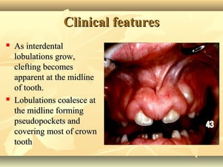 Soft tissue oral lesions in children | PPT