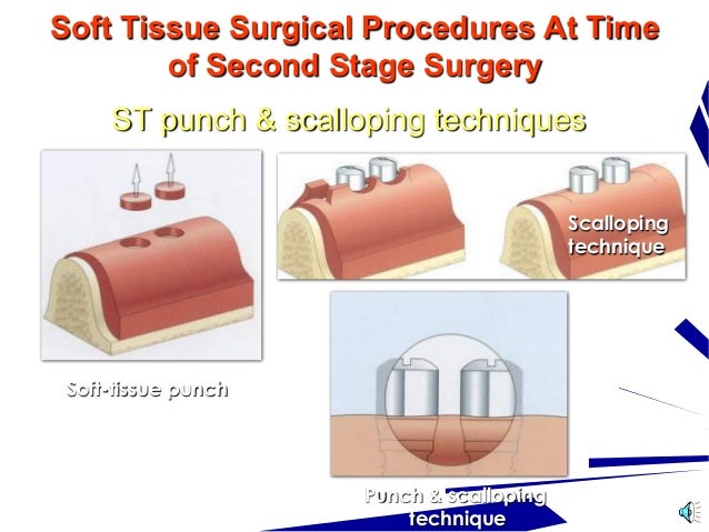 Soft tissue procedures