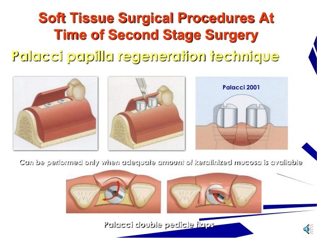 Soft tissue procedures