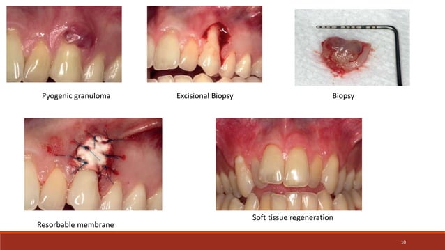 Dental Soft tissue regeneration | PPTX
