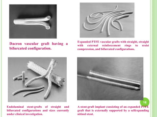 Soft tissue replacement | PPTX