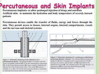 Soft tissue replacement | PPTX