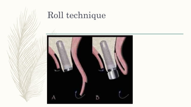 Soft tissue ridge augmentation | PPTX | Dental Health | Diseases and ...