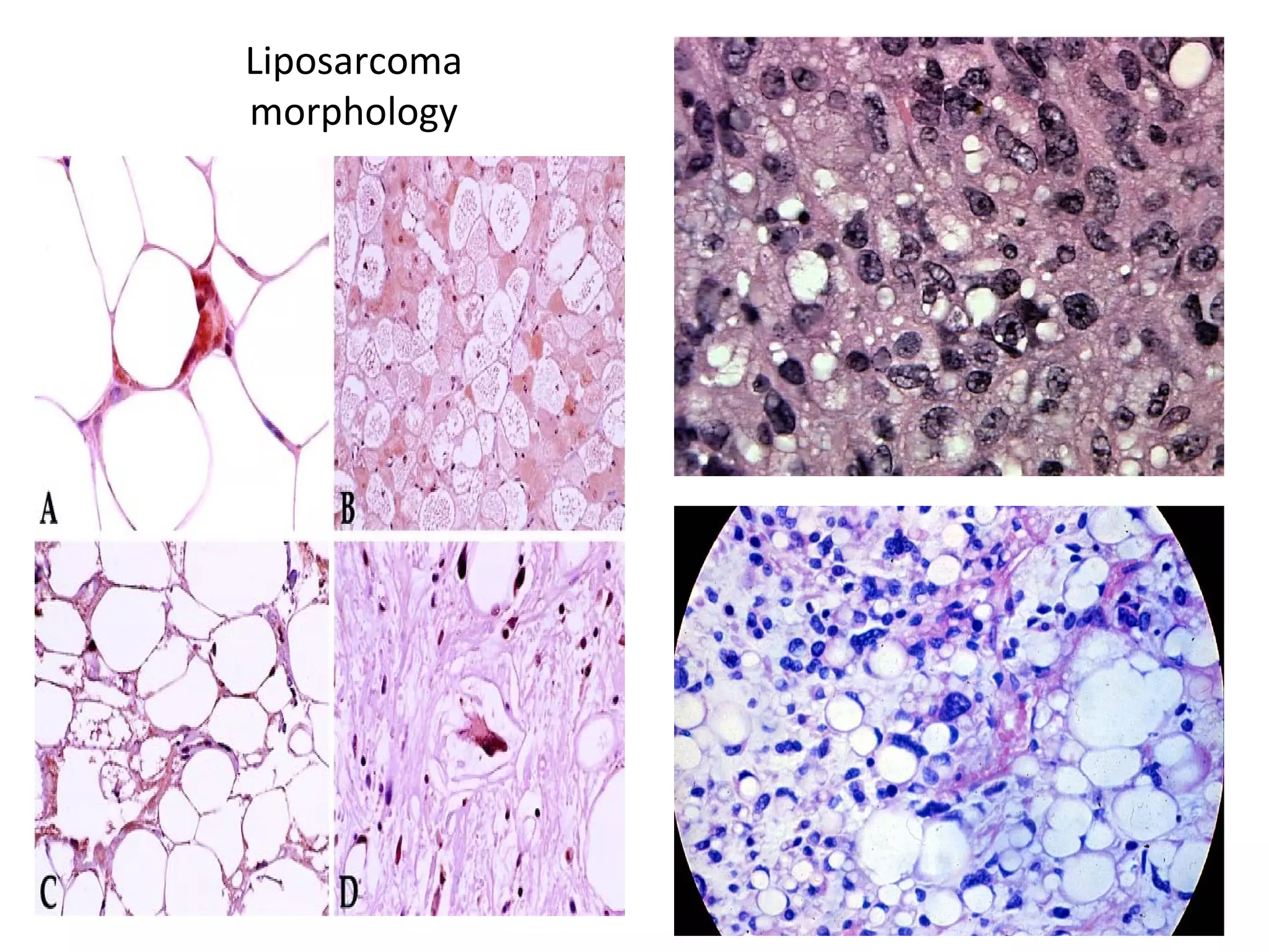 Soft tissue sarcoma | PPT