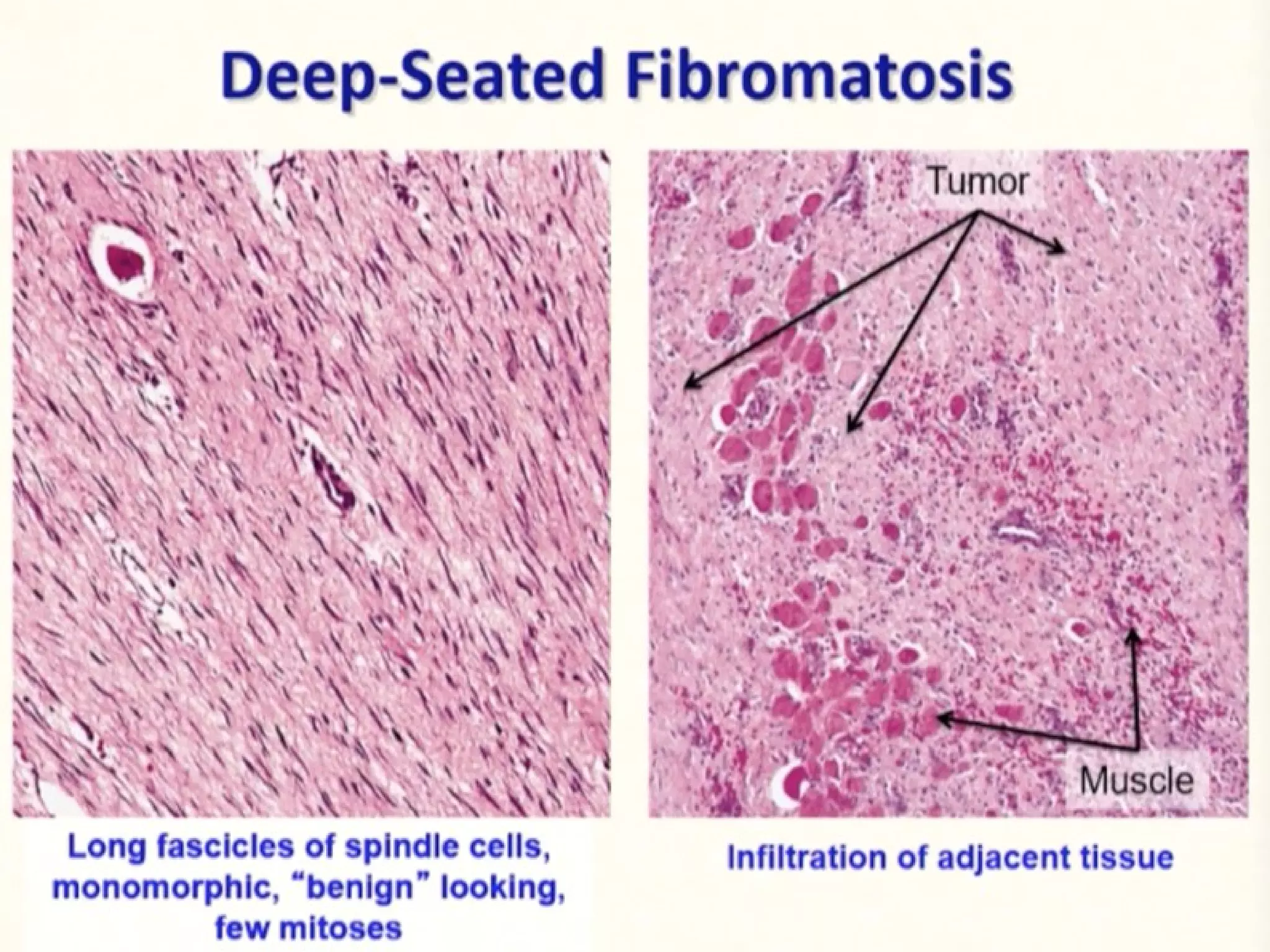 Soft tissue sarcoma | PPT