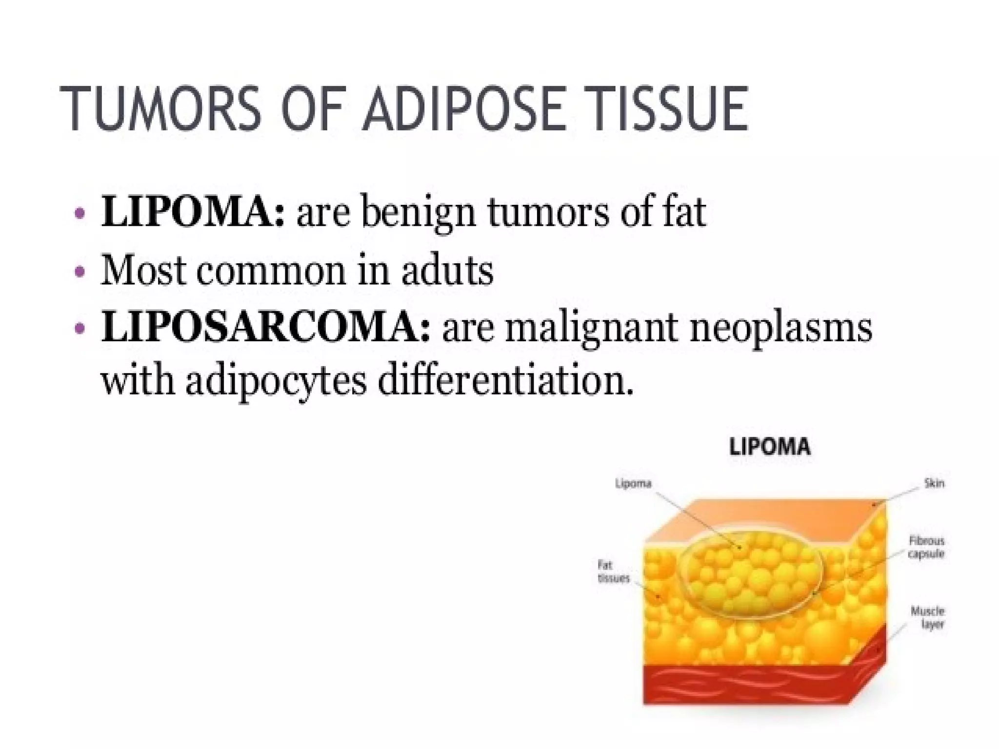 Soft tissue sarcoma | PPT