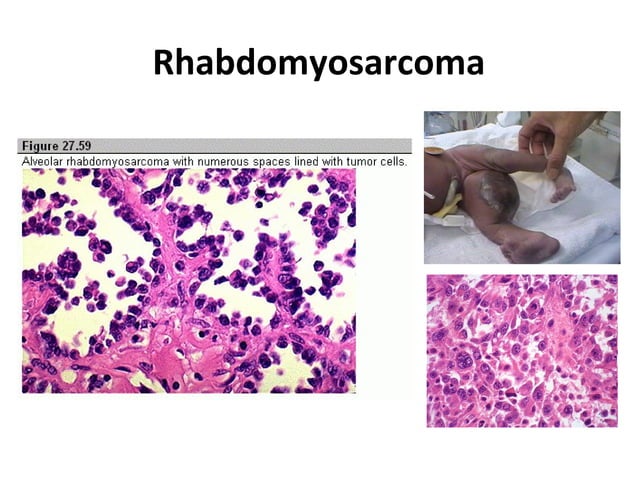 Soft tissue sarcoma | PPT