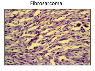 Fibrosarcoma Histology