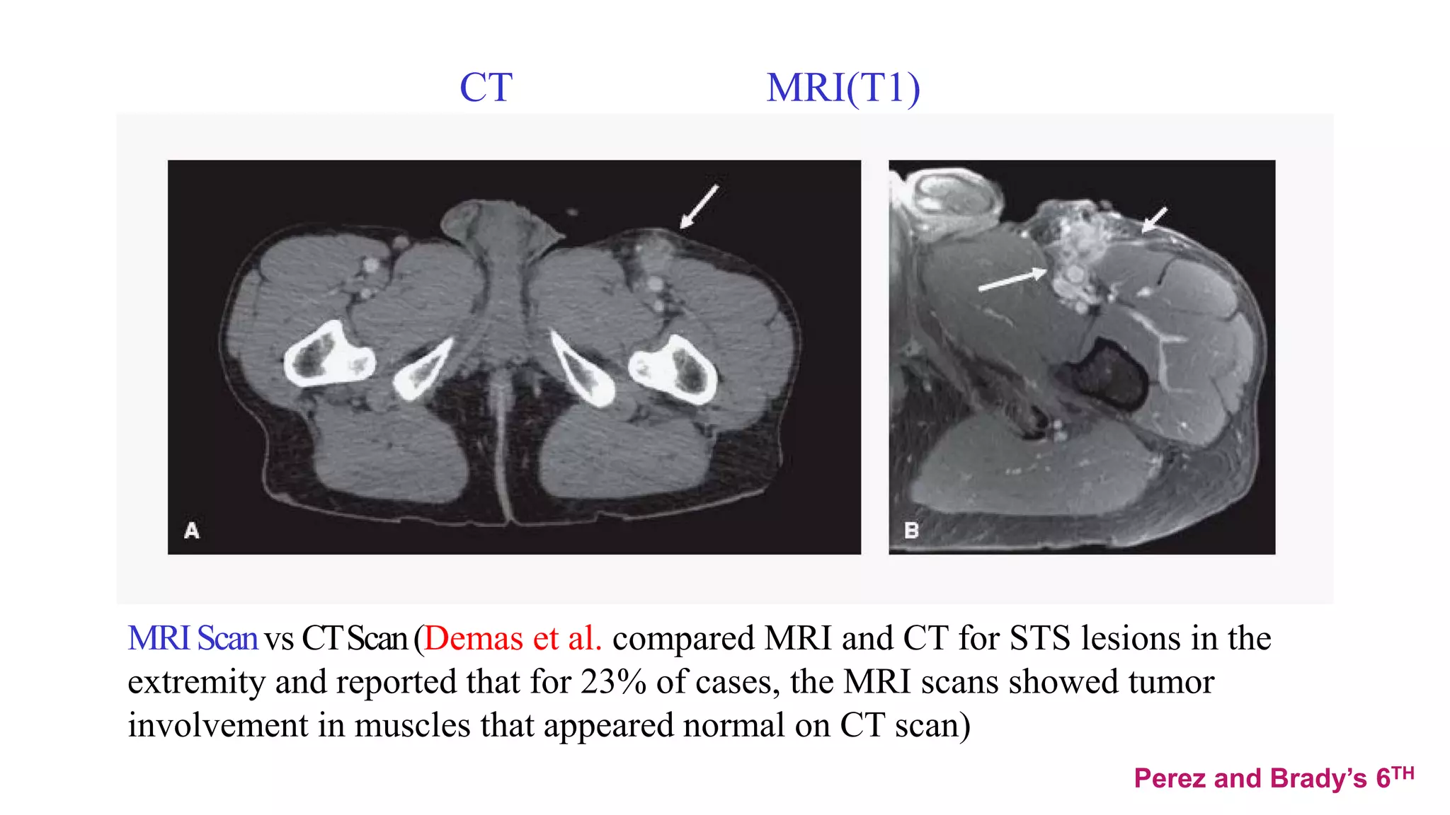 Soft tissue sarcoma | PPTX