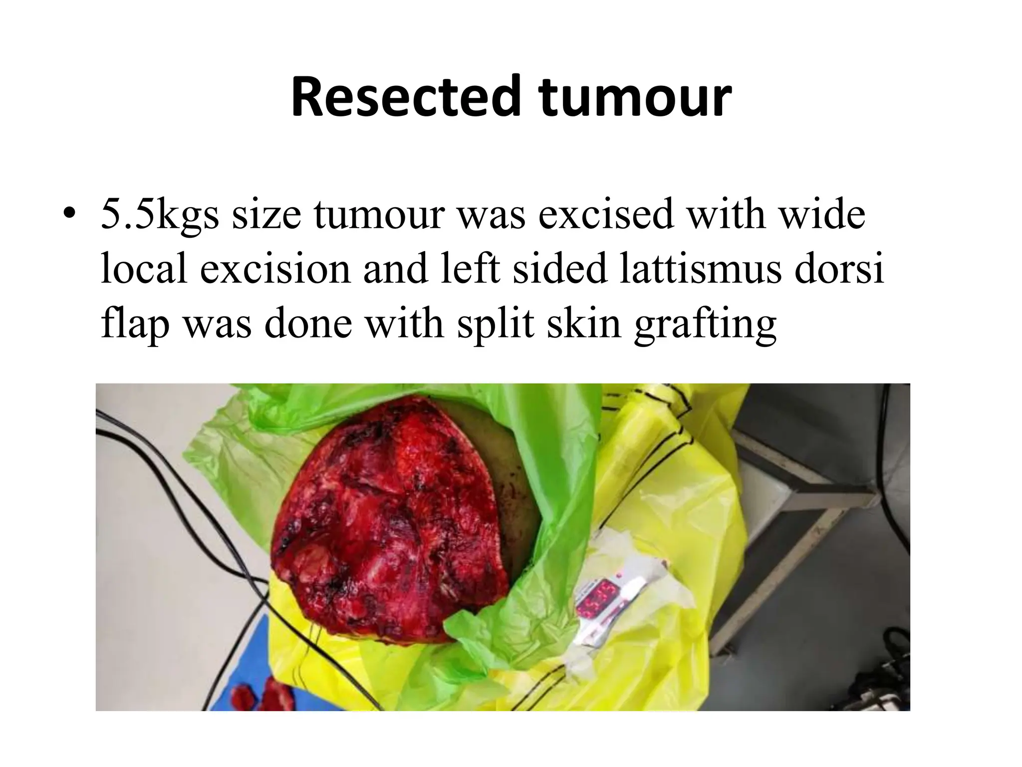 soft tissue sarcoma-case presentation and discussion | PPTX