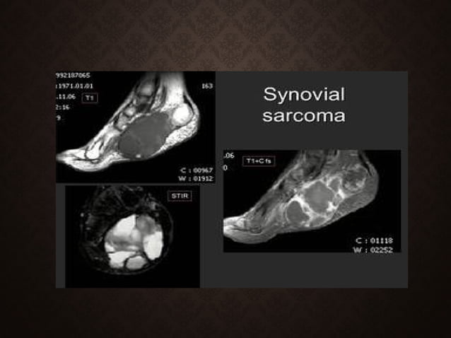 Soft tissue sarcomas | PDF | Cancer | Diseases and Conditions