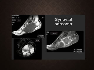 Soft tissue sarcomas | PPT