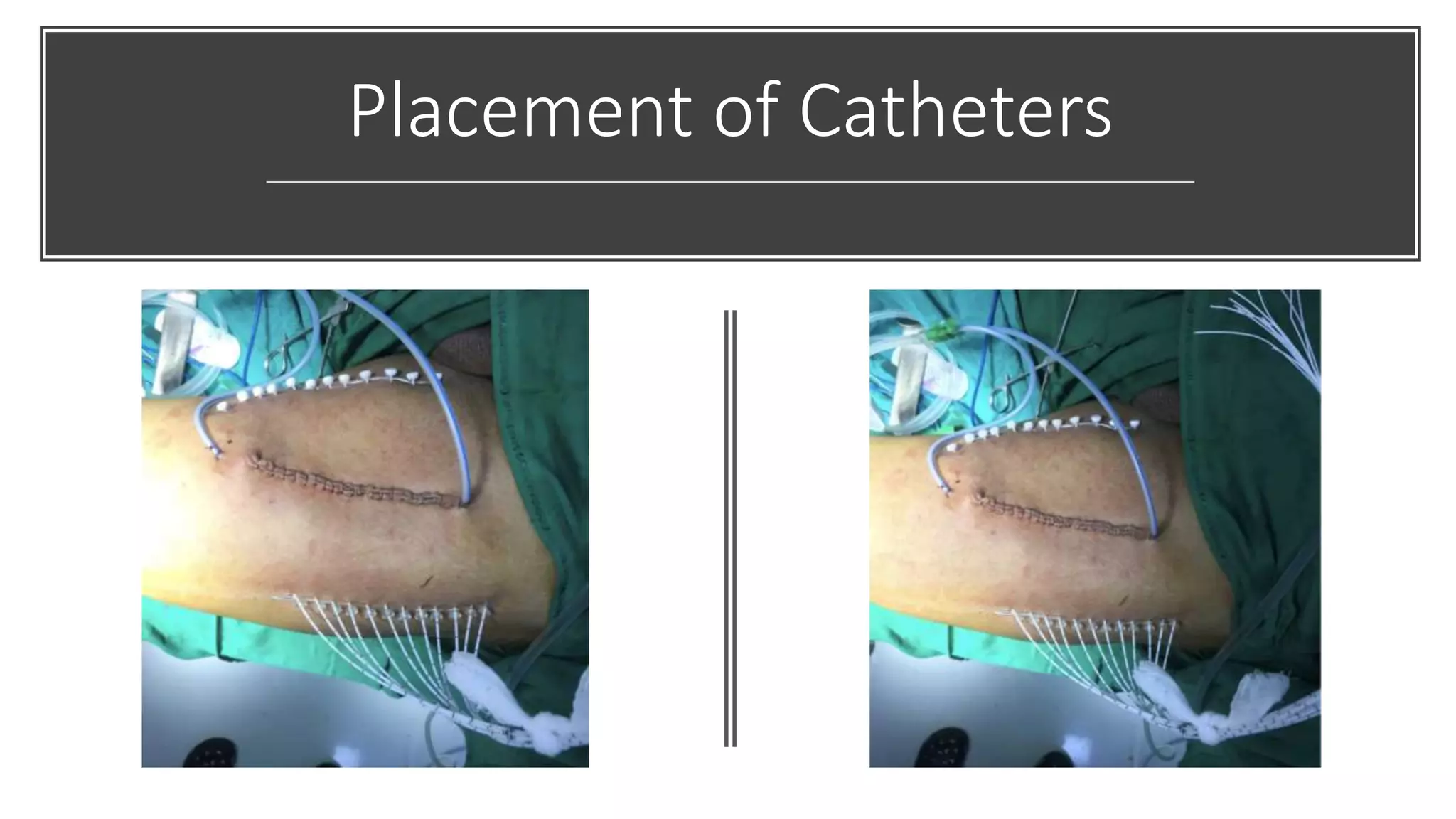 Soft tissue sarcoma brachytherapy | PPTX