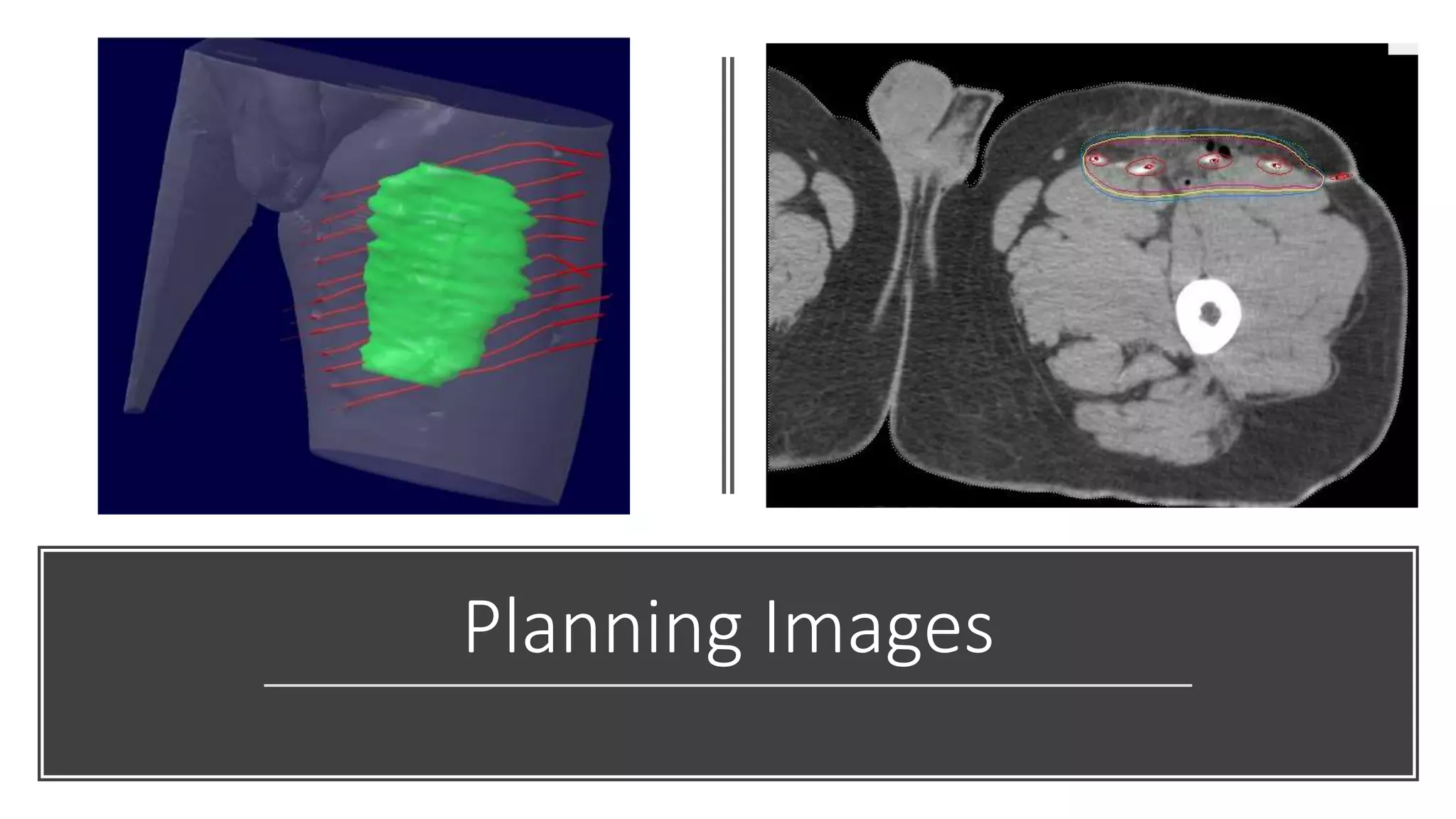 Soft Tissue Sarcoma Brachytherapy Ppt Free Download