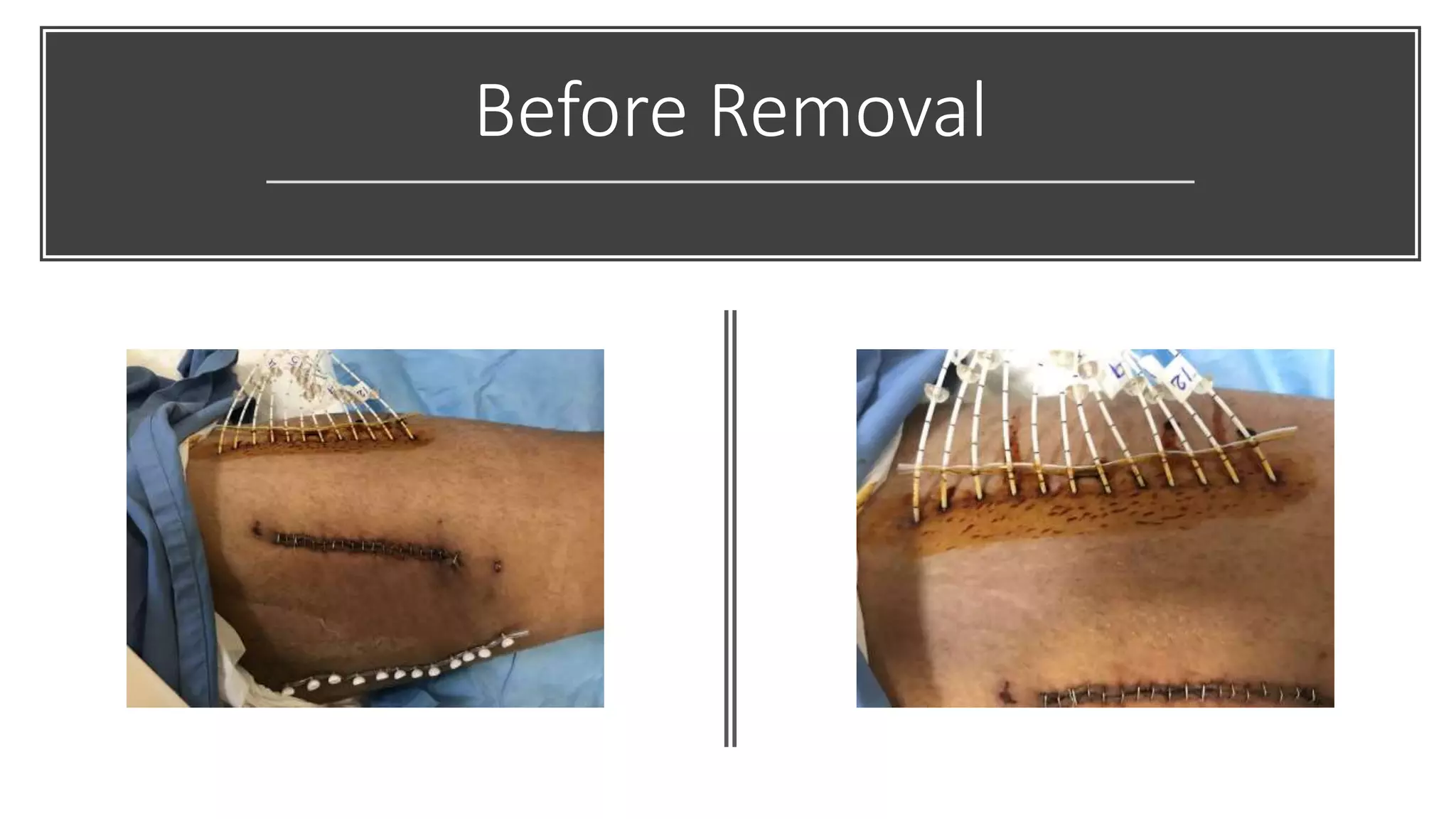 Soft tissue sarcoma brachytherapy | PPTX