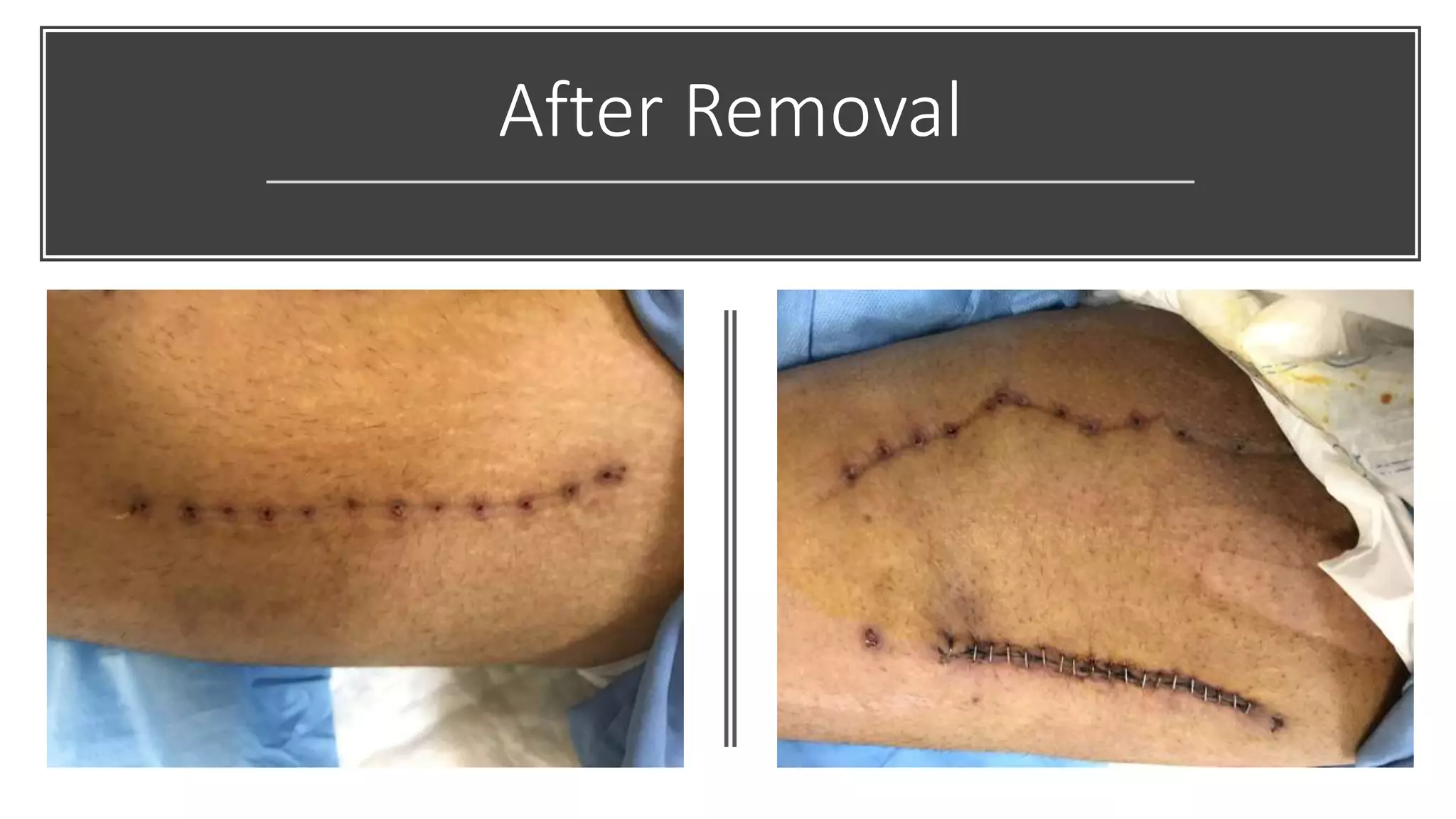 Soft Tissue Sarcoma Brachytherapy Ppt Free Download