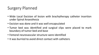 Soft tissue sarcoma brachytherapy | PPTX
