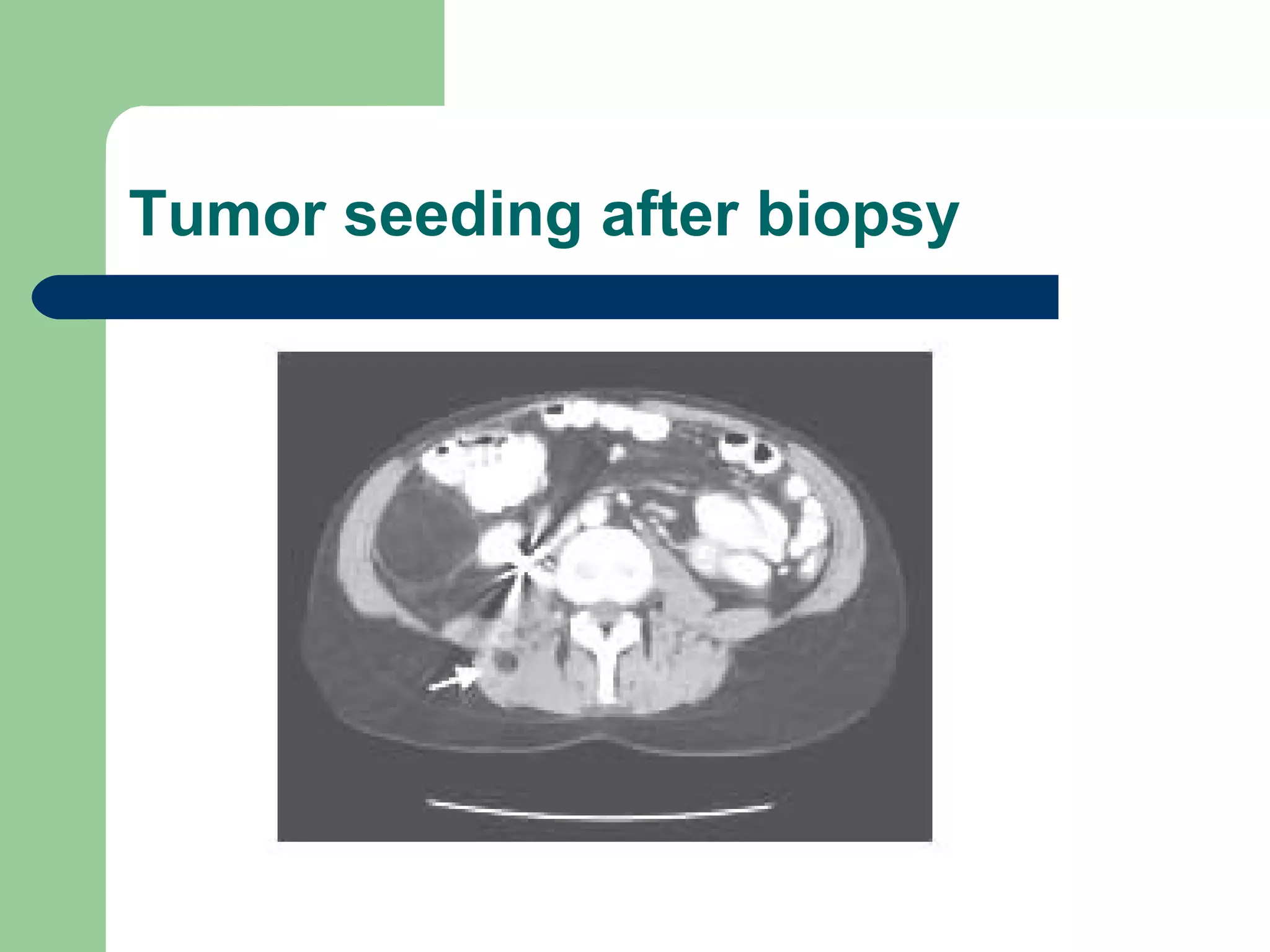 Soft Tissue Sarcomas PPT soft-tissue-sarcomas-ppt