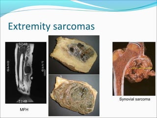 Soft tissue sarcomas, treatment (surgical, radiation, chemotherapy) | PPT