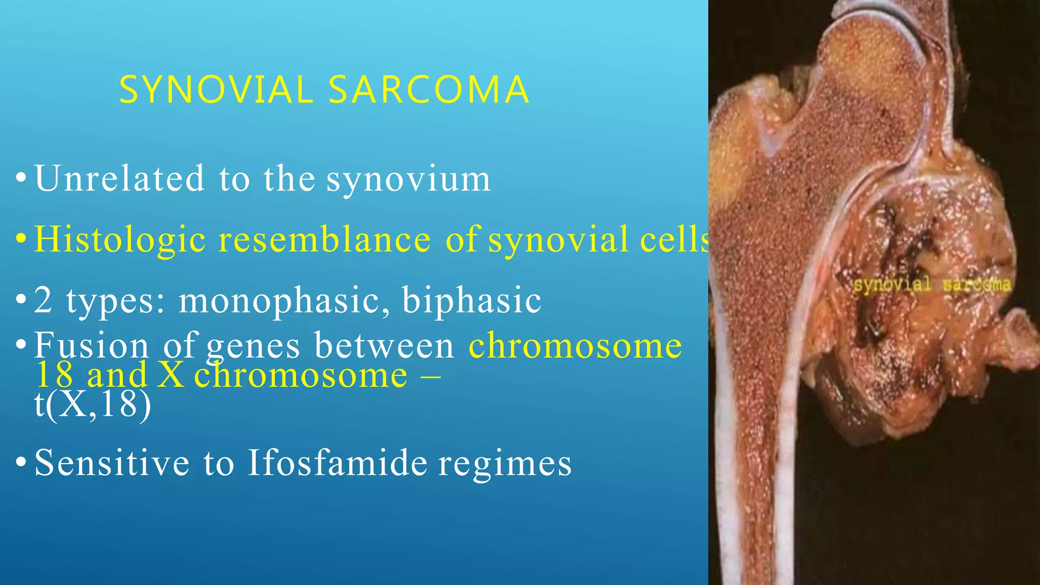 Soft tissue sarcomas | PPTX