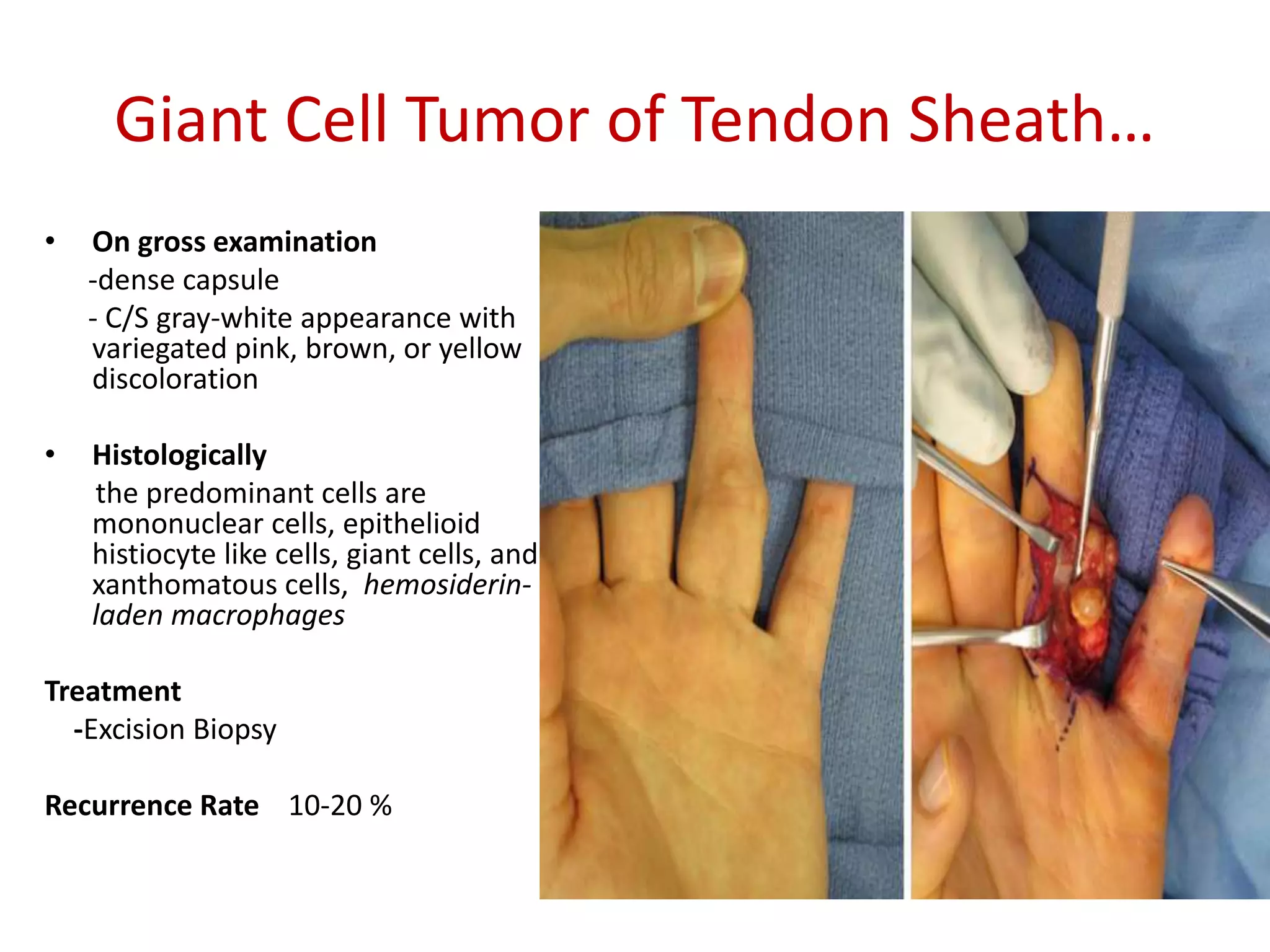 Soft tissue tumor | PPTX