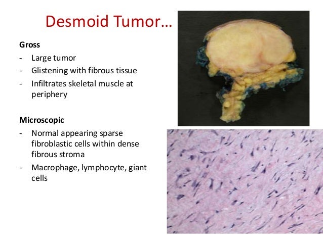 Soft tissue tumor