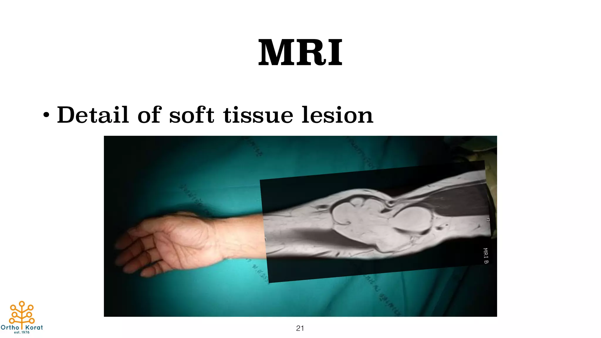 Approach to Soft Tissue Tumor in Upper Extremity | PDF