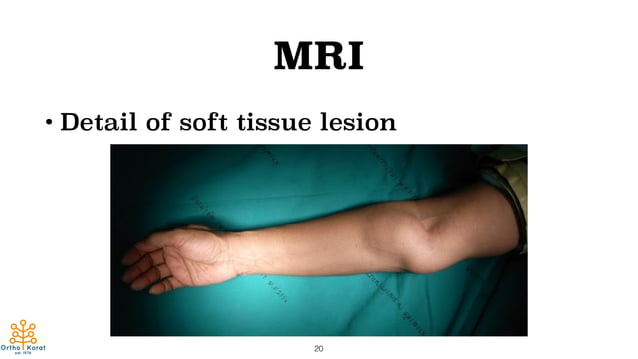 Approach to Soft Tissue Tumor in Upper Extremity | PDF