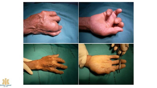 Approach to Soft Tissue Tumor in Upper Extremity | PDF