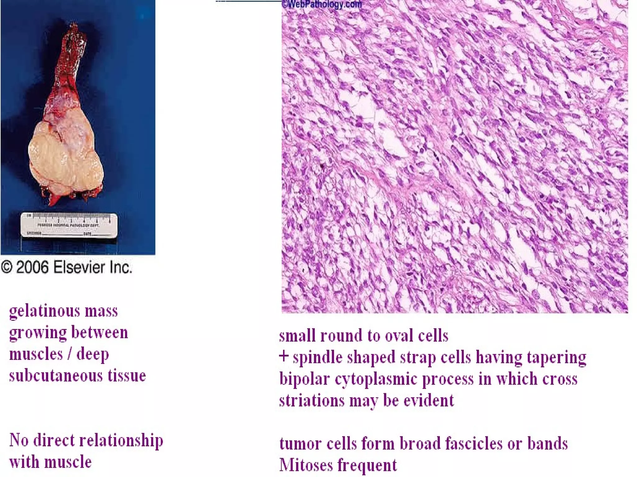 Soft tissue tumors | PPT