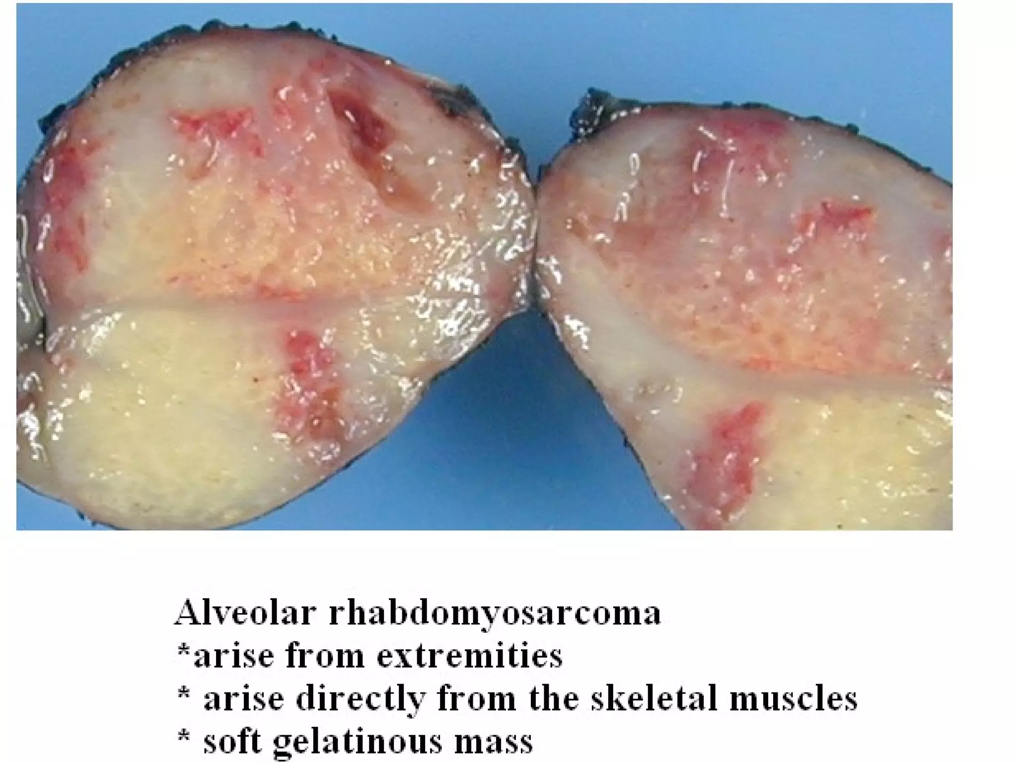 Soft tissue tumors | PPT