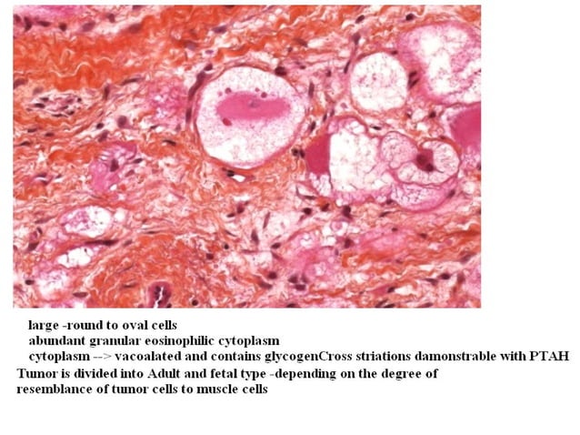 Soft tissue tumors | PPT | Medical Health
