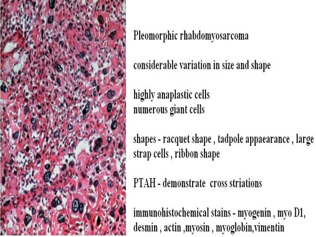 Soft tissue tumors | PPT | Medical Health