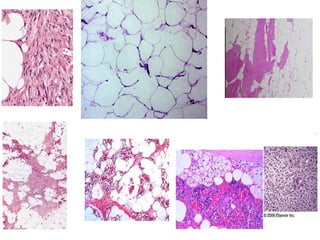 Soft tissue tumors | PPT