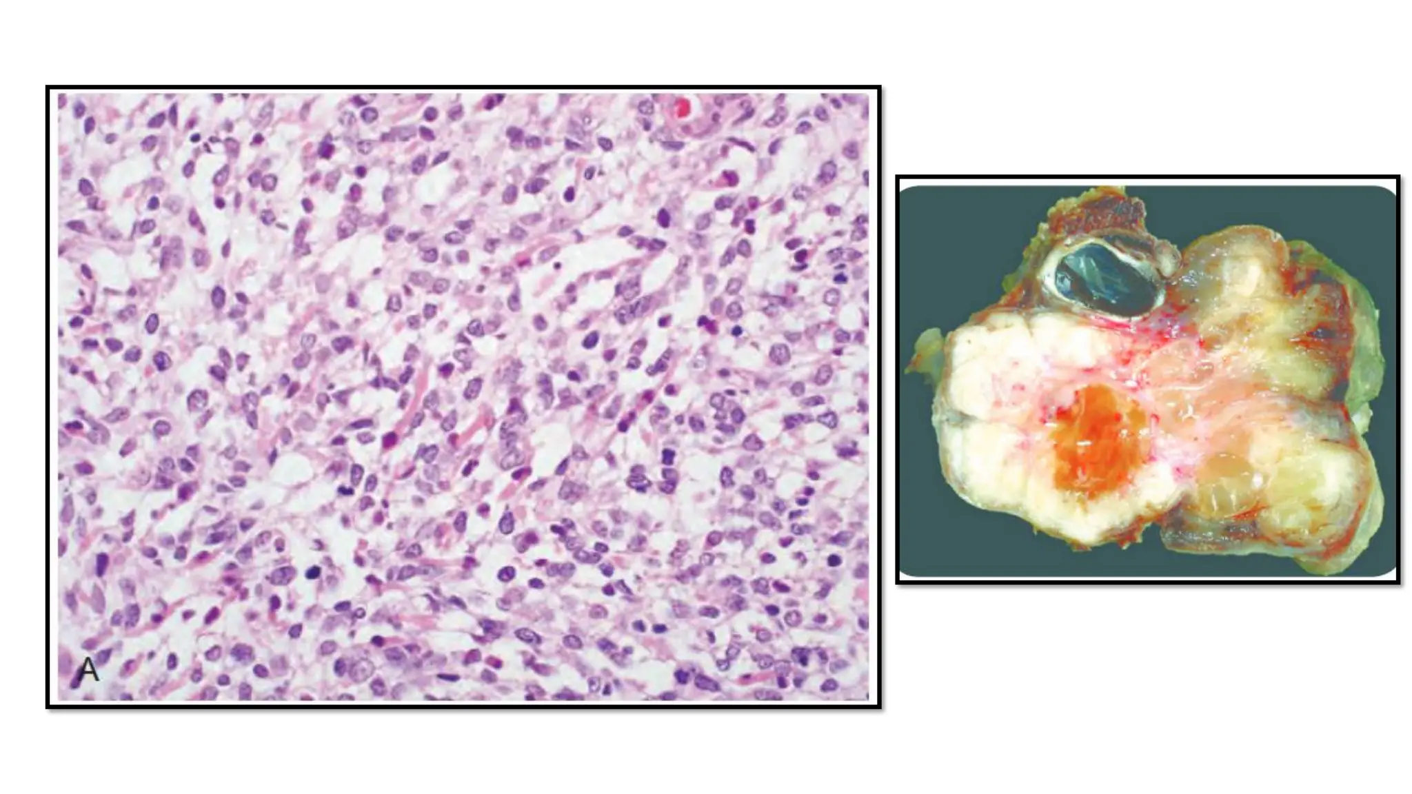 SOFT TISSUE TUMORS PATHOLOGY PRESENTATION | PDF