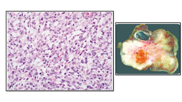 SOFT TISSUE TUMORS PATHOLOGY PRESENTATION | PDF