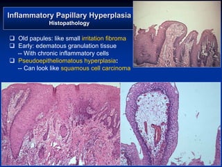 Inflammatory Papillary Hyperplasia Histology