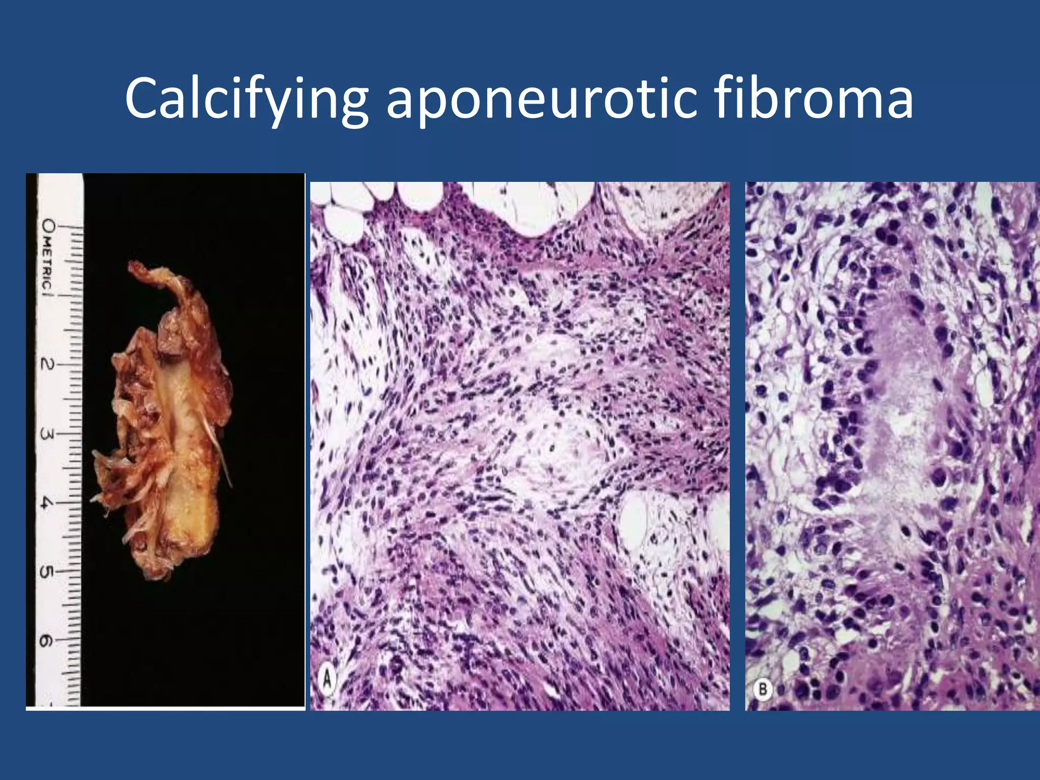 Soft tissue tumor | PPTX | Cancer | Diseases and Conditions