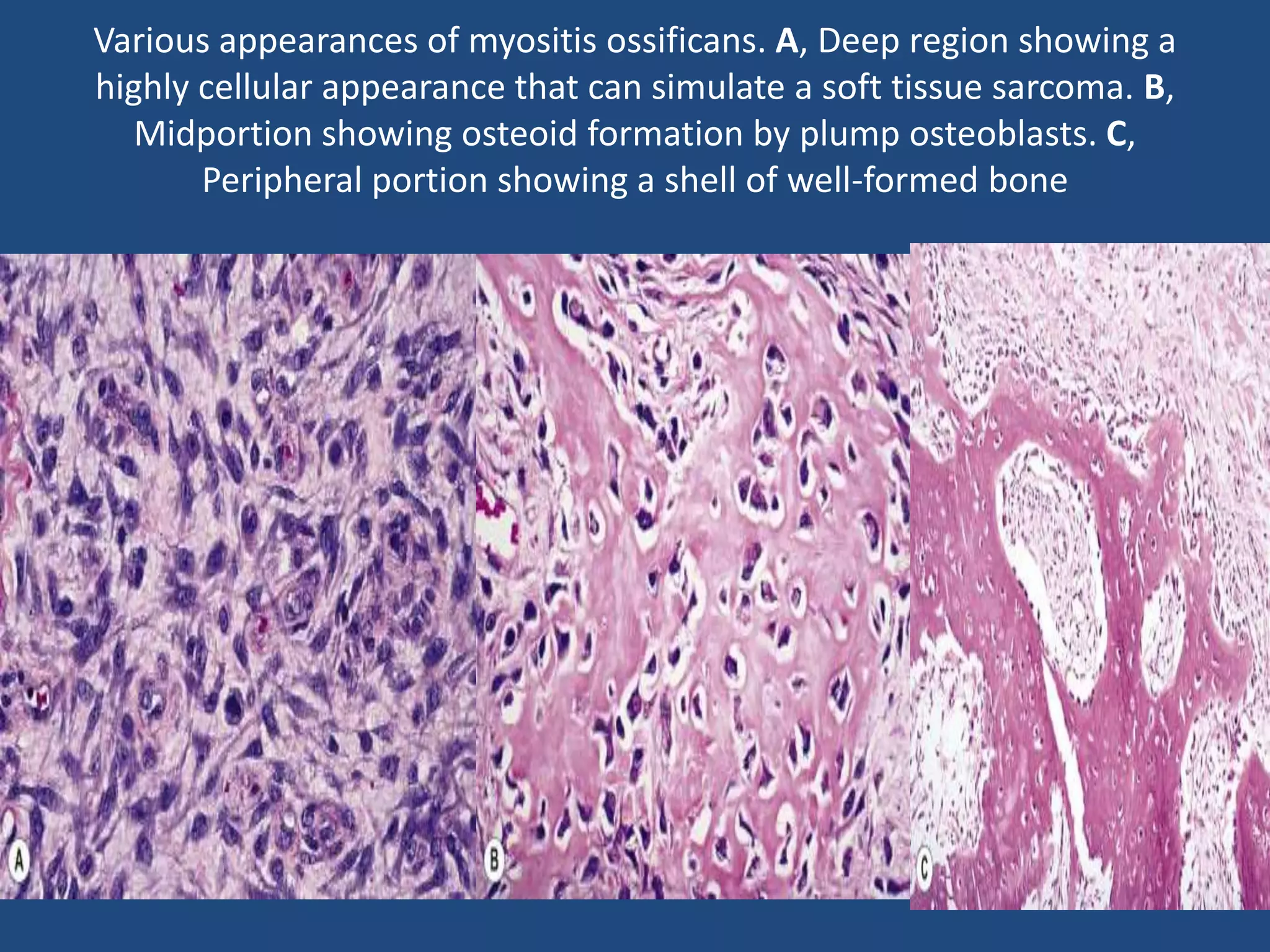 Soft tissue tumor | PPTX