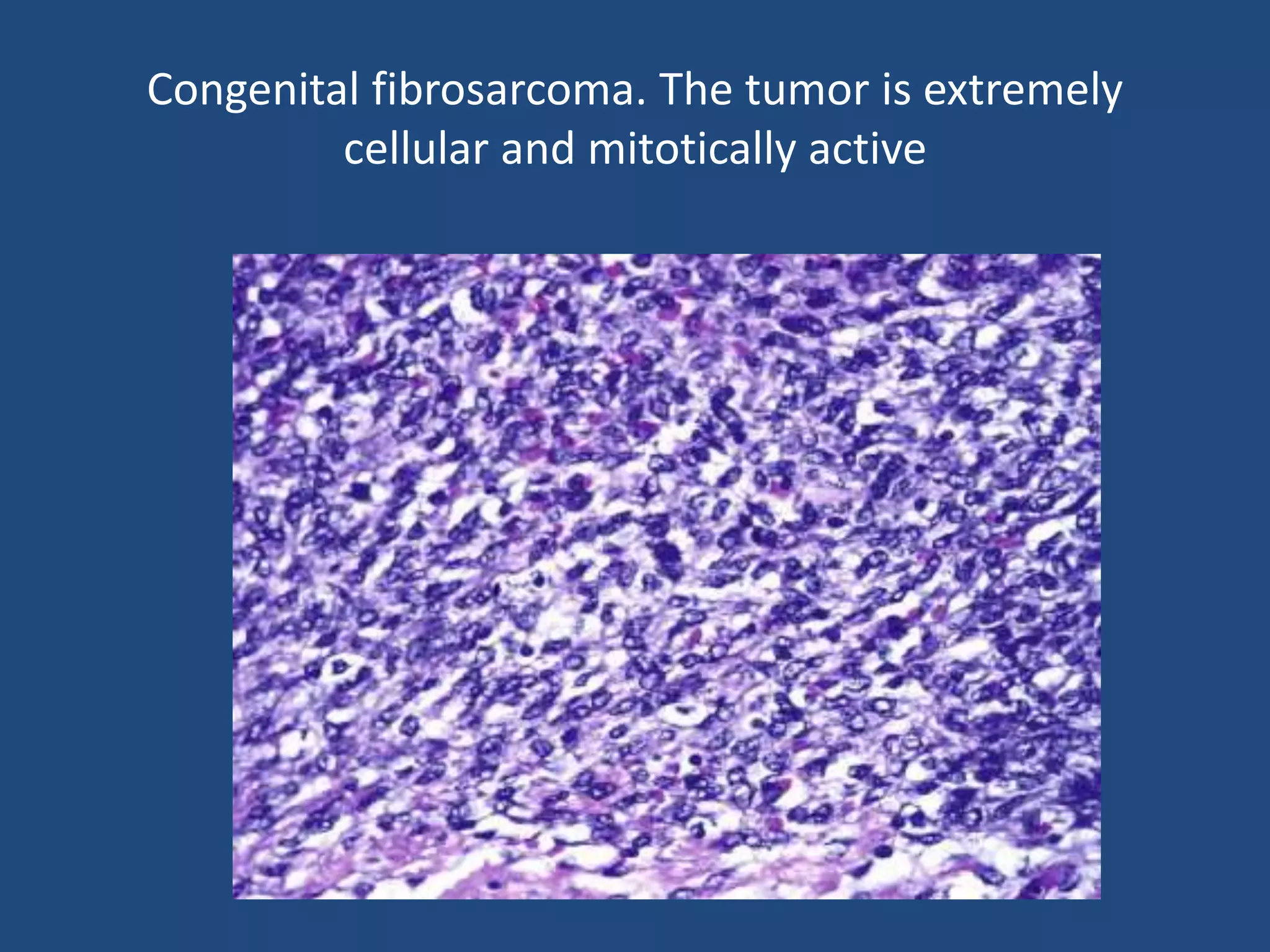 Soft tissue tumor | PPTX