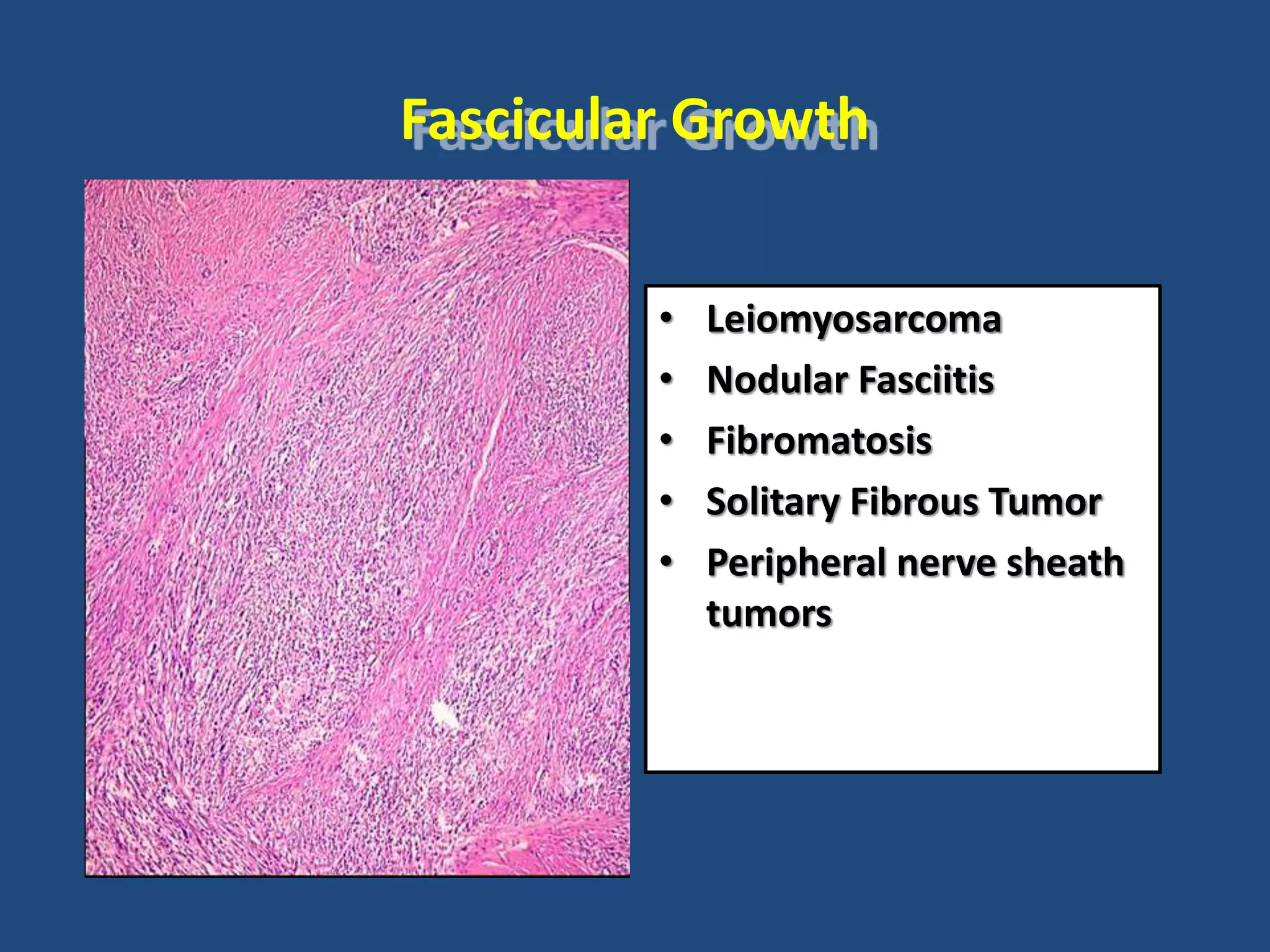 Soft tissue tumor | PPTX