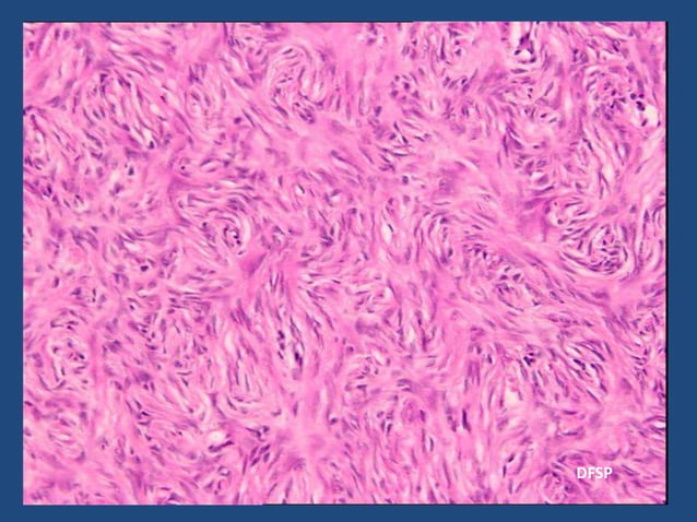 Soft tissue tumor | PPTX | Cancer | Diseases and Conditions