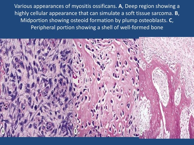 Soft tissue tumor | PPTX | Cancer | Diseases and Conditions