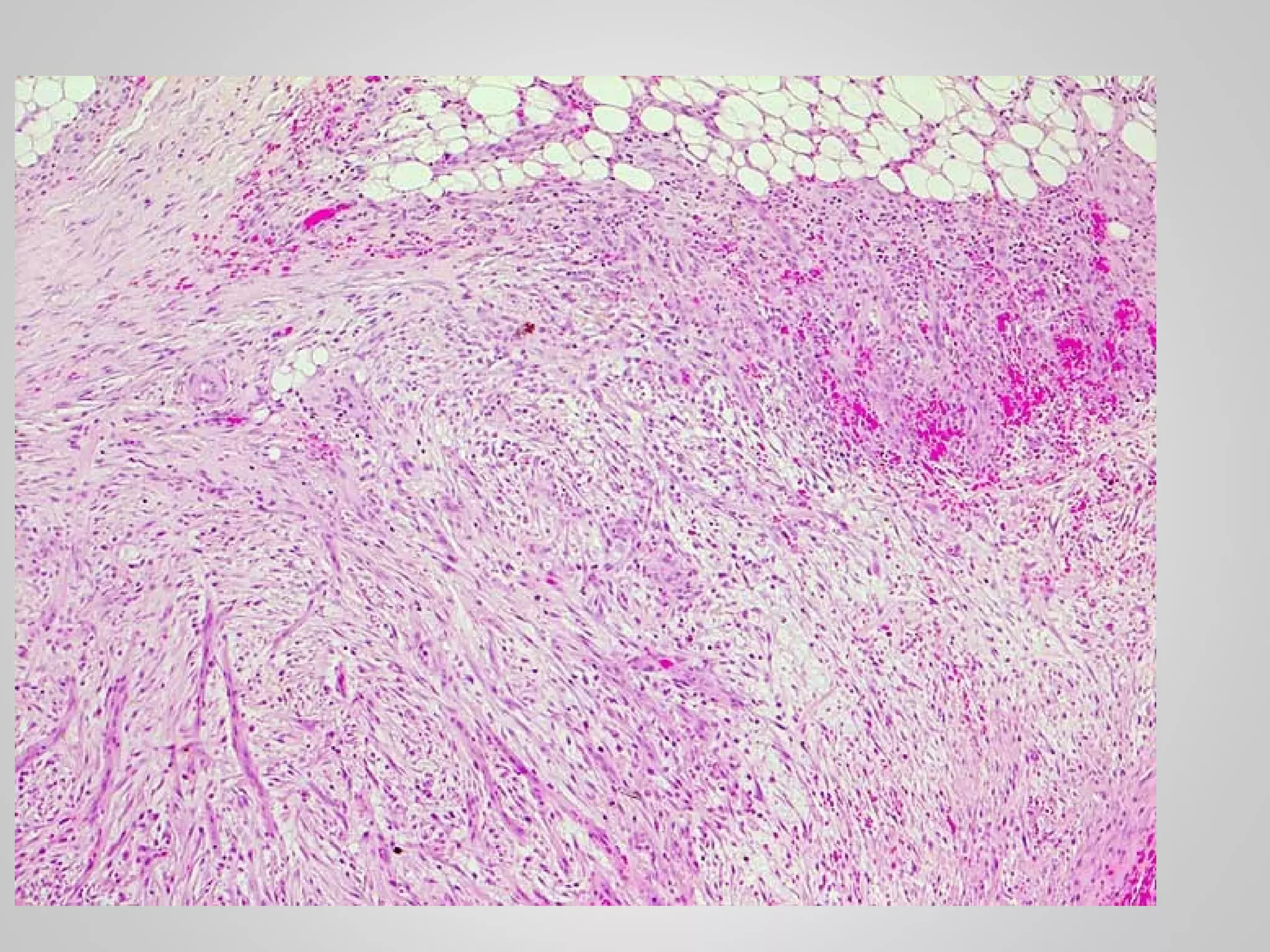 Soft tissue tumours | PPT | Cancer | Diseases and Conditions