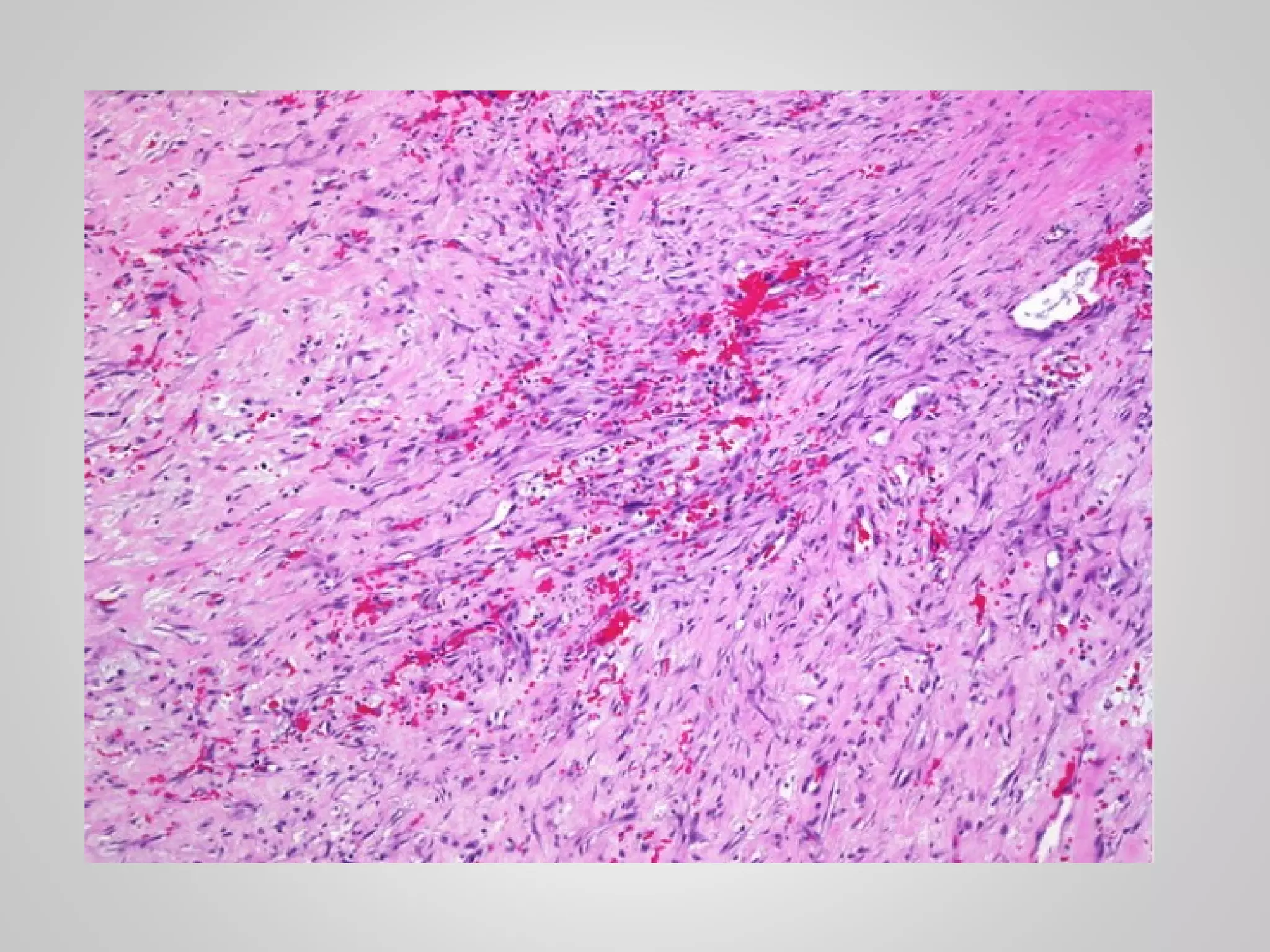 Soft tissue tumours | PPT | Cancer | Diseases and Conditions