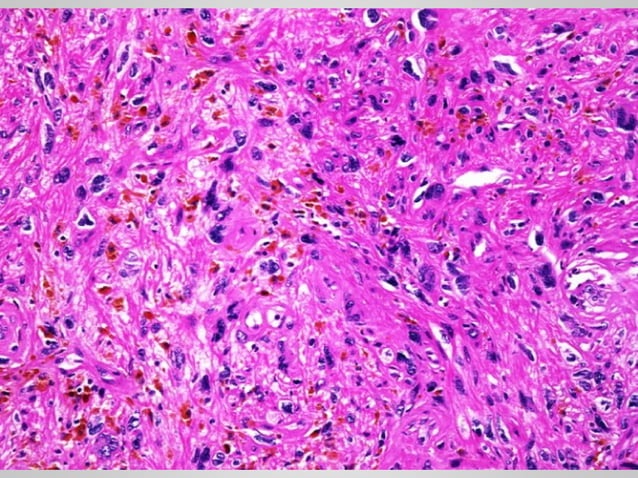 Soft tissue tumours | PPT | Cancer | Diseases and Conditions