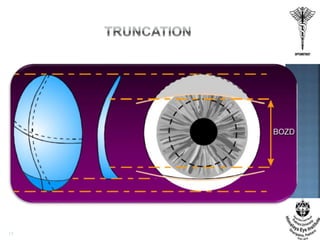 SOFT TORIC CONTACT LENS FITTING.pptx